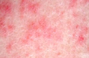 Leukemia:This leaves a person prone to infection