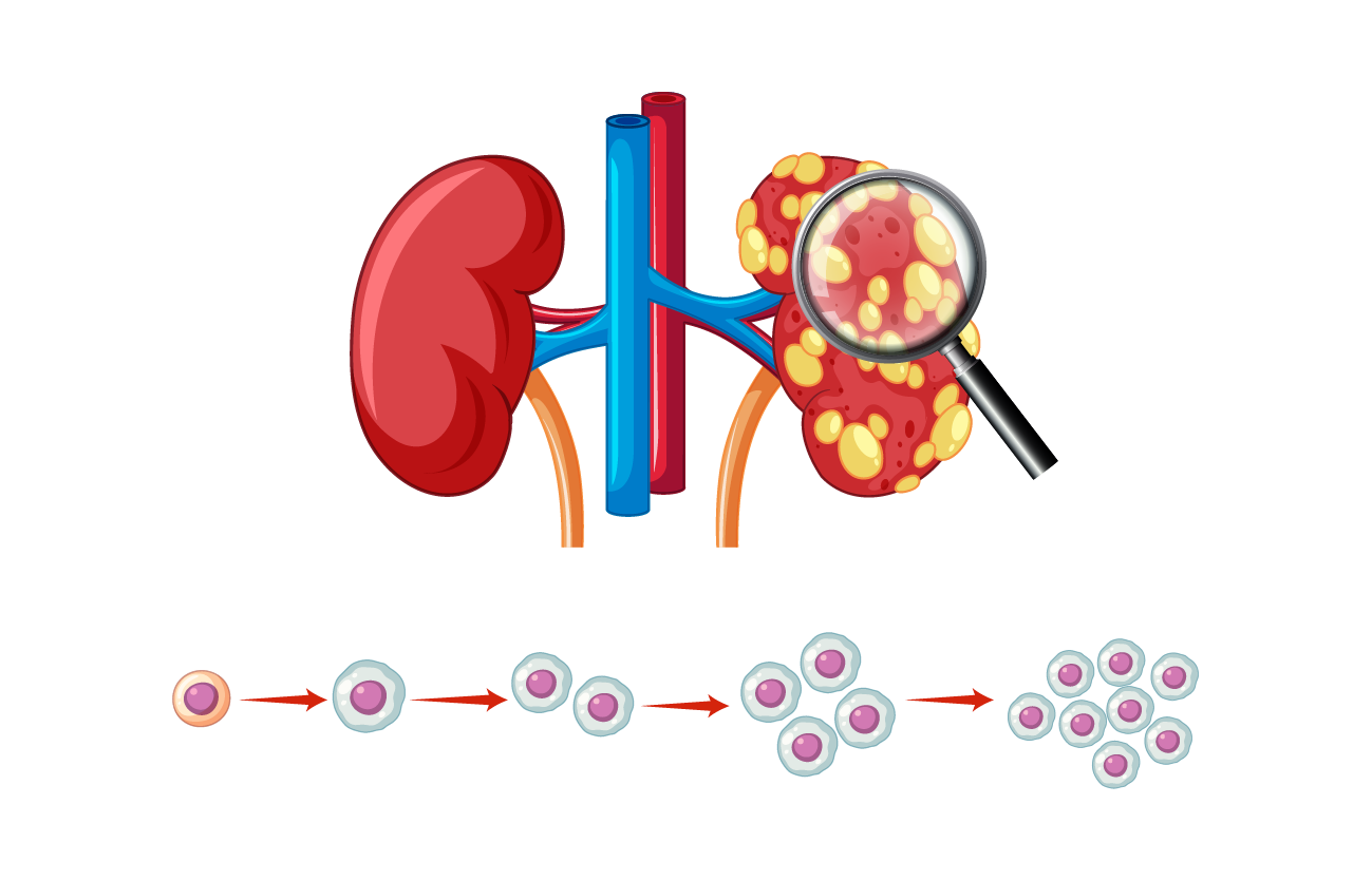 Kidney Cancer - Artofhealing Cancer
